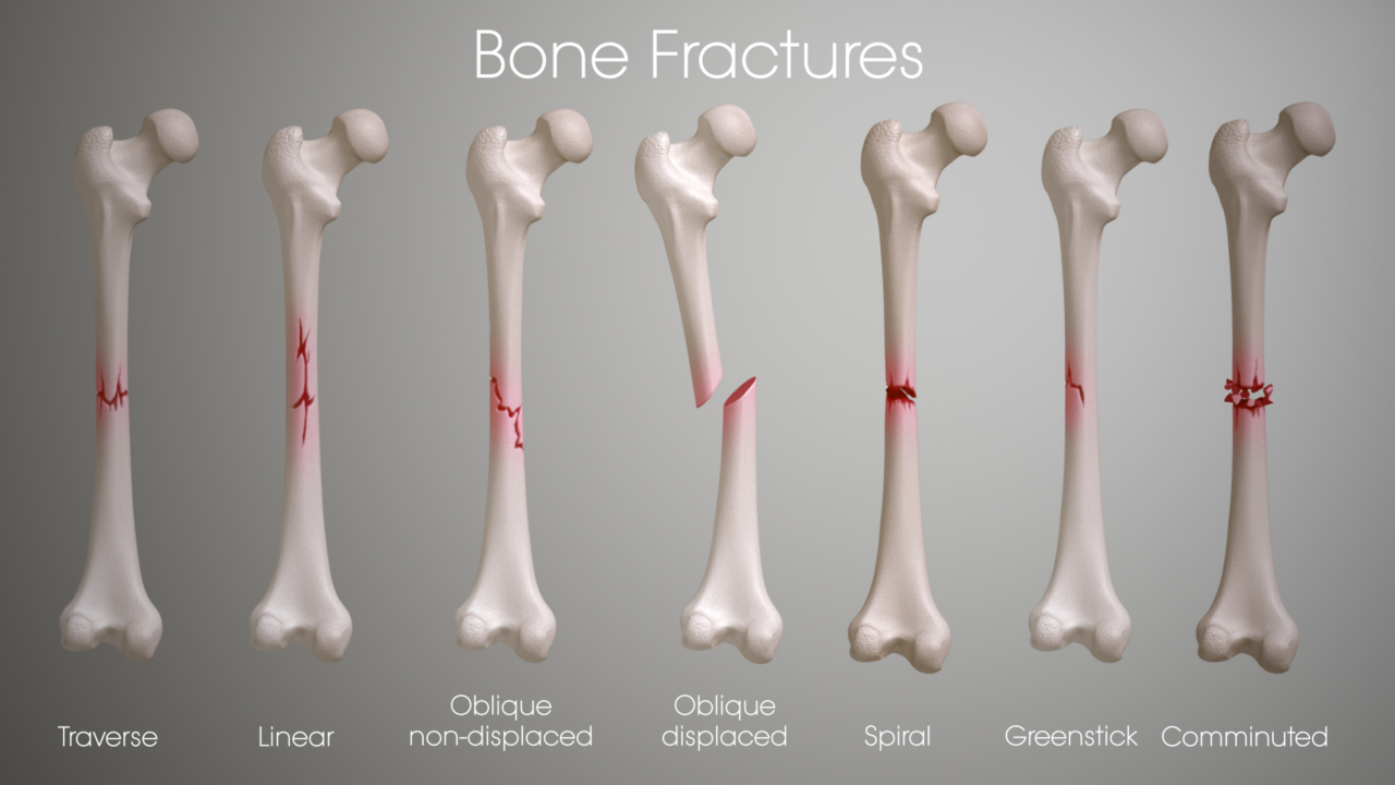 Paediatric Fractures: types, symptoms, treatments for kids fractures