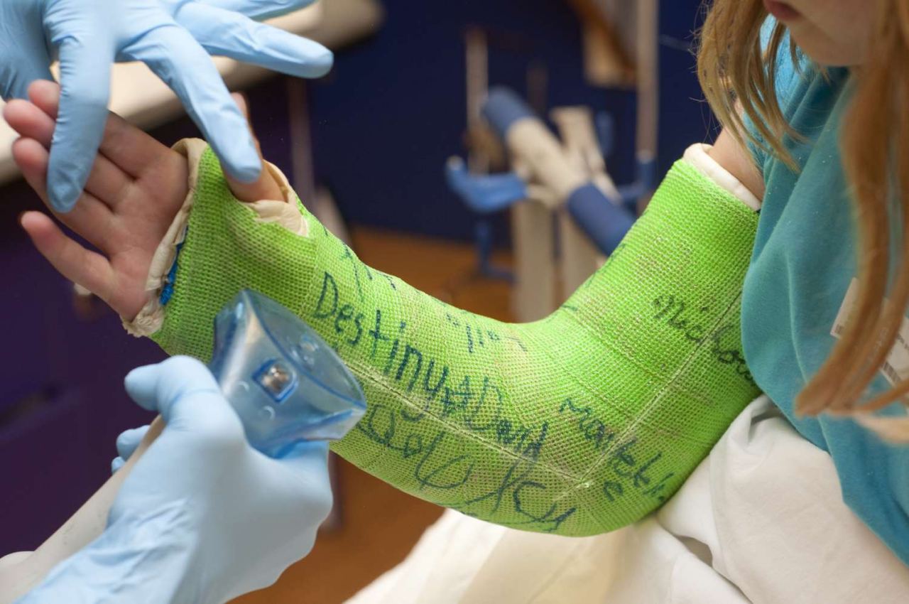 After Cast Removal - what to do after fracture cast removal