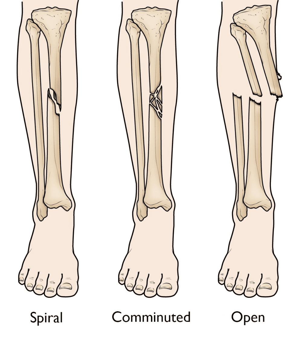 Paediatric Fractures: types, symptoms, treatments for kids fractures