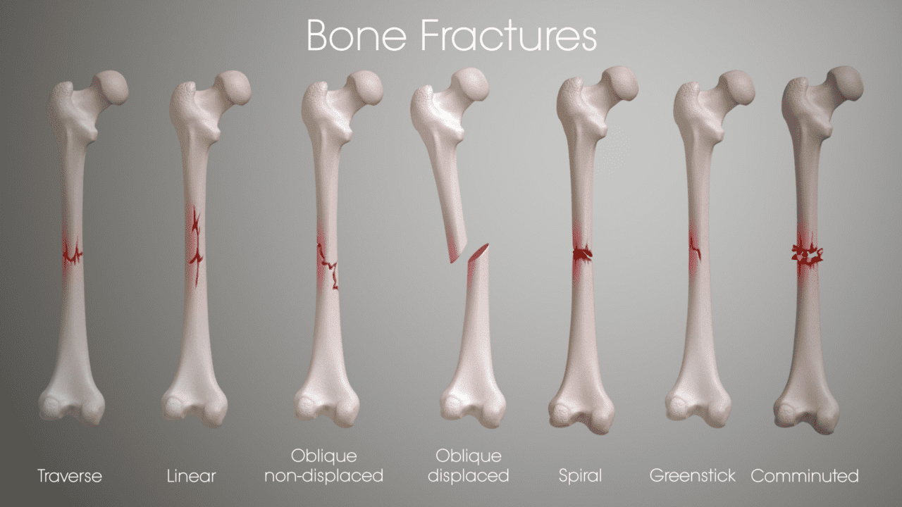 Paediatric Fractures: types, symptoms, treatments for kids fractures