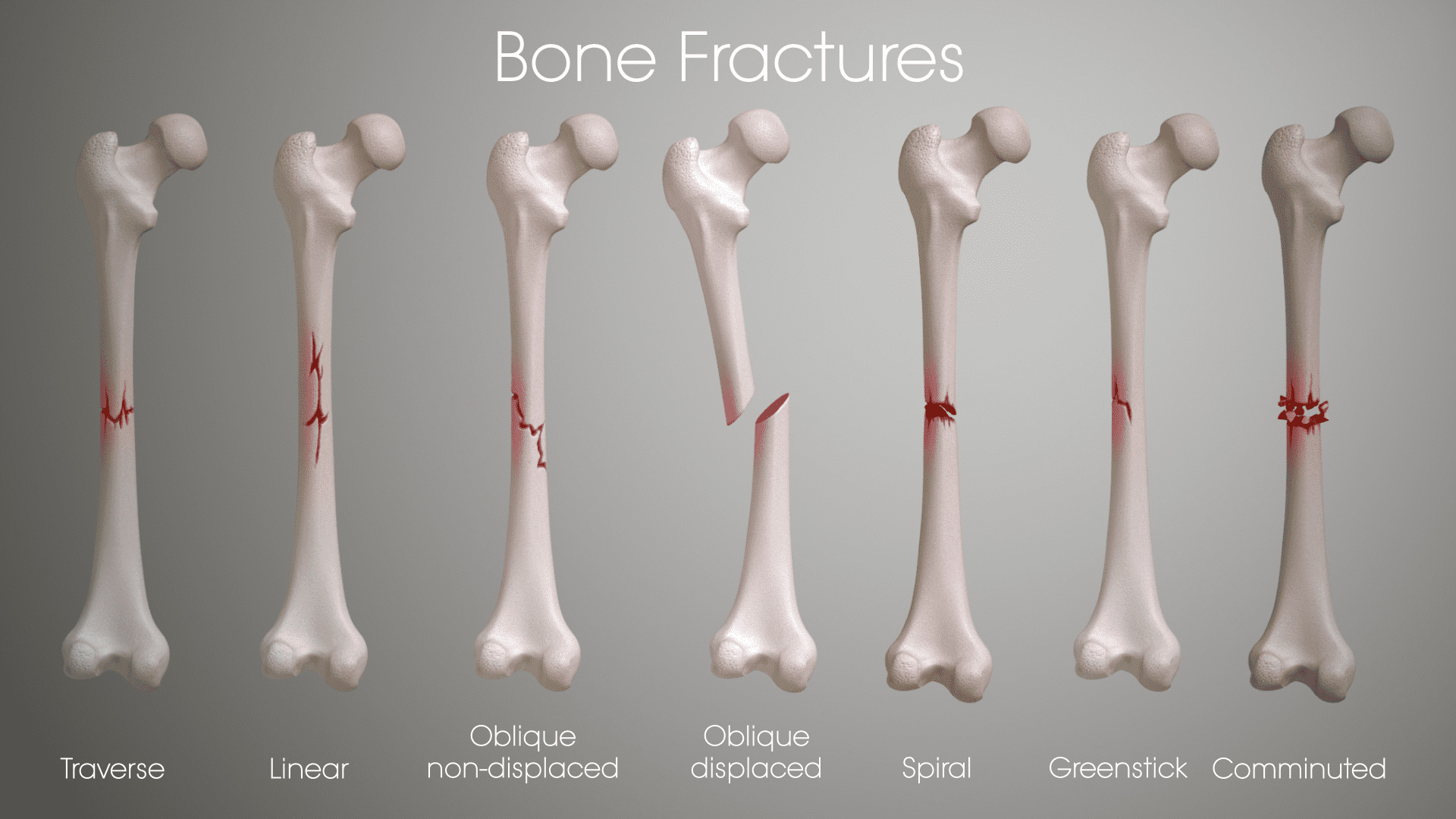 Paediatric Fractures: types, symptoms, treatments for kids fractures