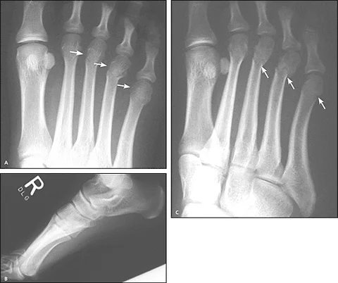 metatarsal bone broken